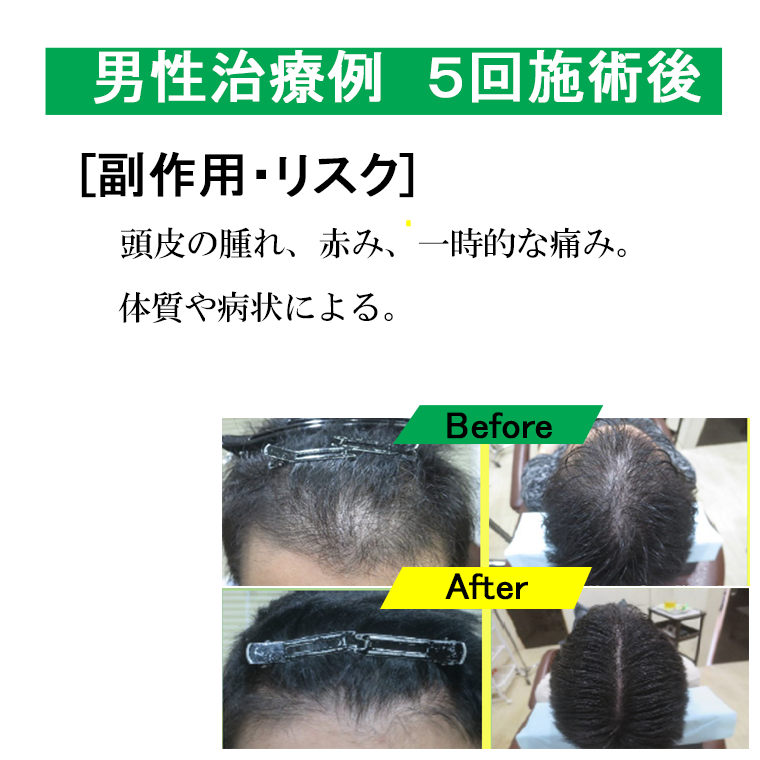 つむじハゲ・てっぺんハゲの診断基準は？見分け方、原因、治し方を徹底解説｜AGA・薄毛・抜毛治療の乃木坂メディカルクリニック